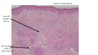 Dermatopathology Made Simple - Inflammatory: Granulomatous Reaction Pattern