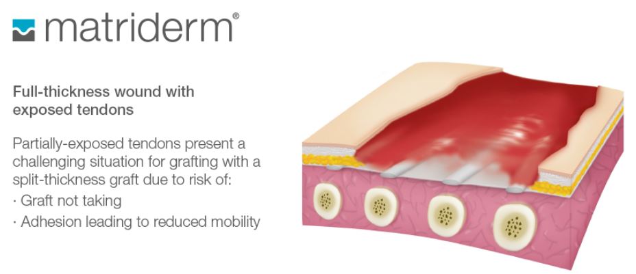 Graftnesis -the infinite regeneration : MatriDerm