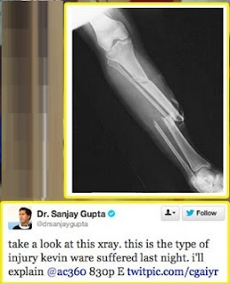 Cardinals Basketball: Kevin Ware: X-ray and Why He Vows to Never Watch ...