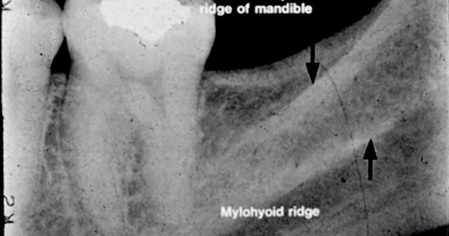 WEBINAR: Dental Radiographic Anatomy - Melanie Helmke - Odonto-Tv