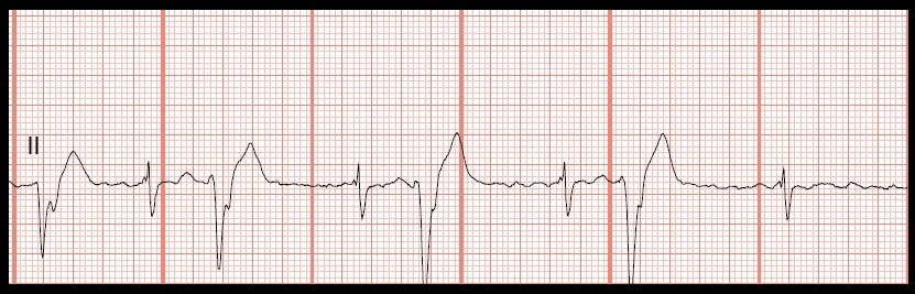 Practice EKG Rhythm Strips 191
