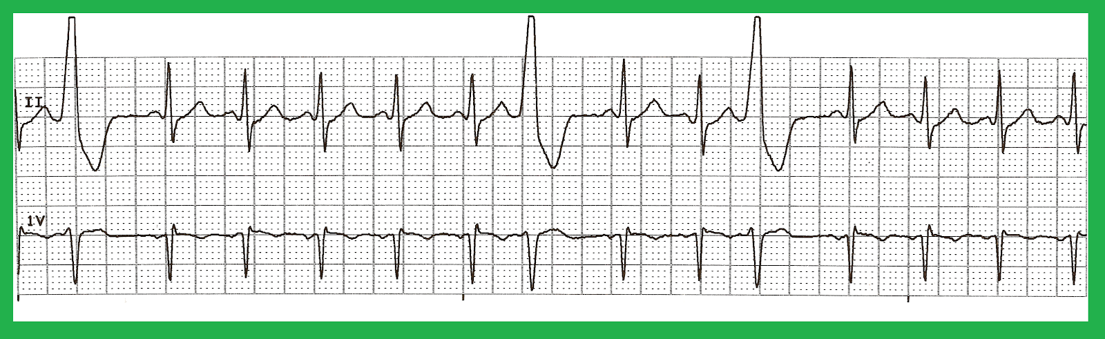 Practice EKG Strips 325