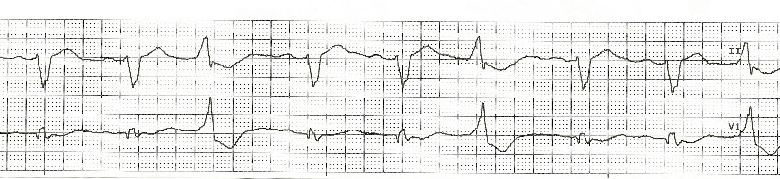 EKG Rhythm Strip Quiz 90