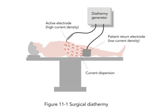 OTMANAGE: ELECTRIC EQUIPMENT 6 Surgical Diathermy