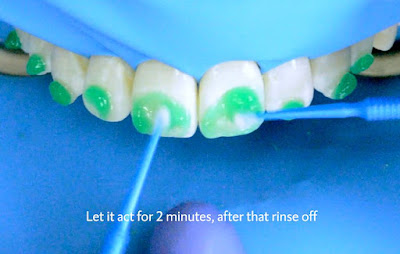 DENTAL FLUOROSIS: Treatment using Icon infiltration, step by step ...