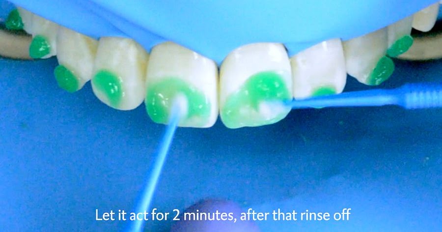 DENTAL FLUOROSIS: Treatment using Icon infiltration, step by step ...