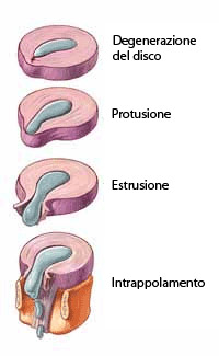 Giuliano Gil : Artrite, artrosi, spondiloartrosi CERVICALE: cura ed ...