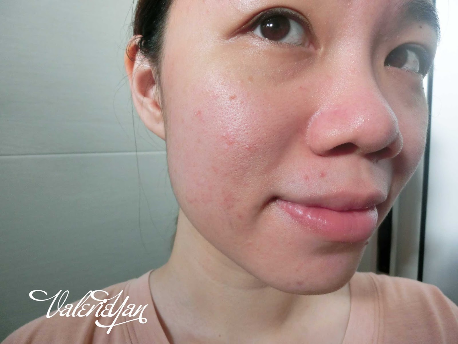 everything about life: Tips on how do I get an acne free face