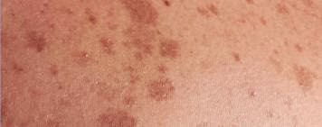 Tener Buena Salud: Cómo deshacerse de las manchas marrones oscuras en ...