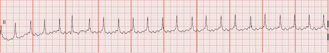EKG Rhythm Strips 85: Atrial Flutter