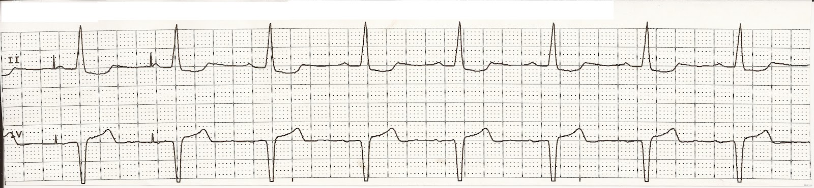 EKG Rhythm Strip Quiz 56: Paced Rhythms