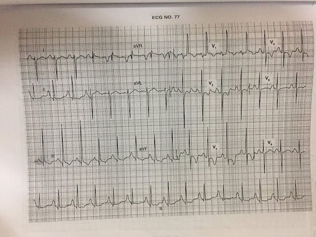 ECG EXERCISE 75,76,77,78