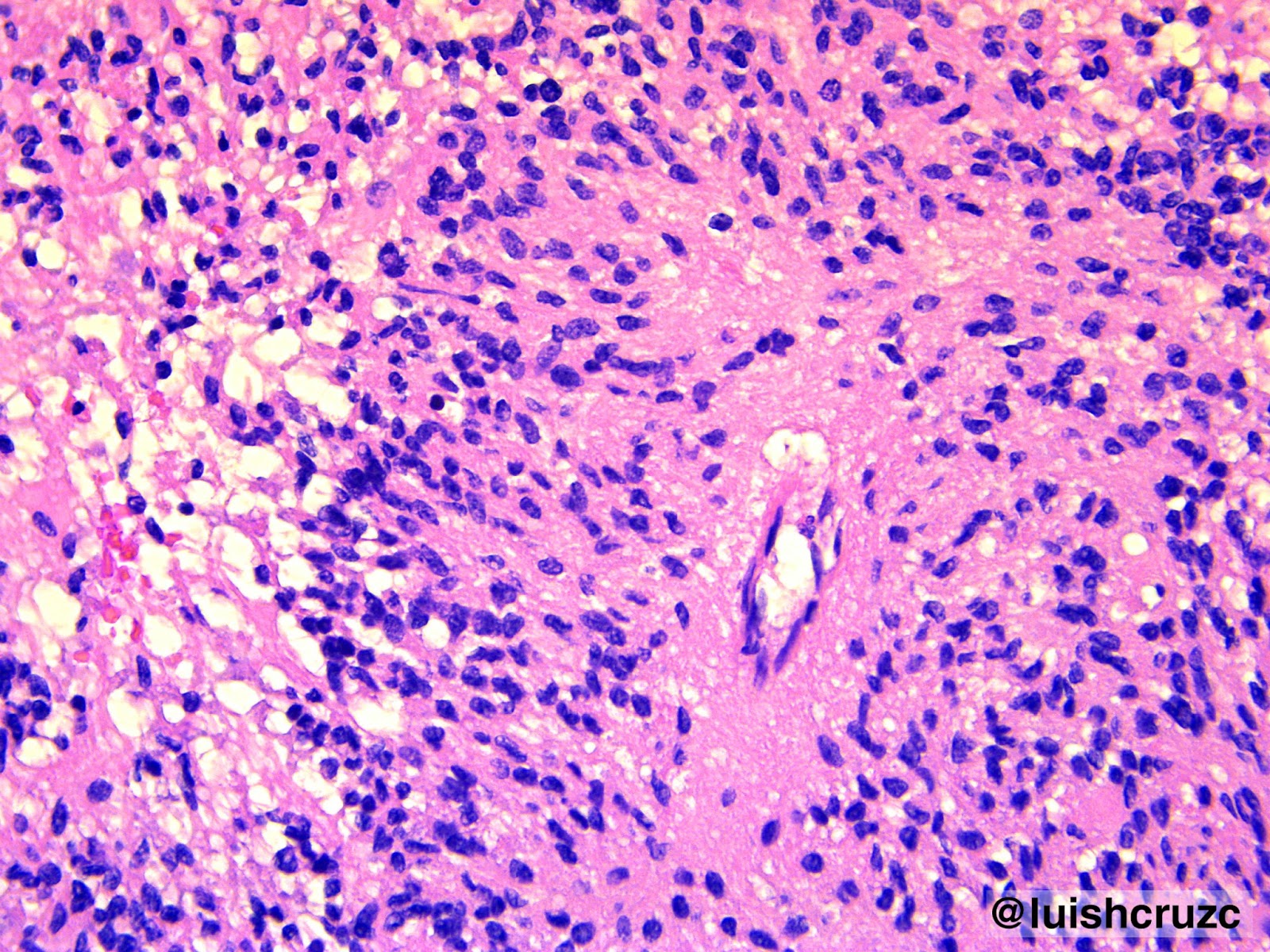 Patología CC: Ependimoma clásico