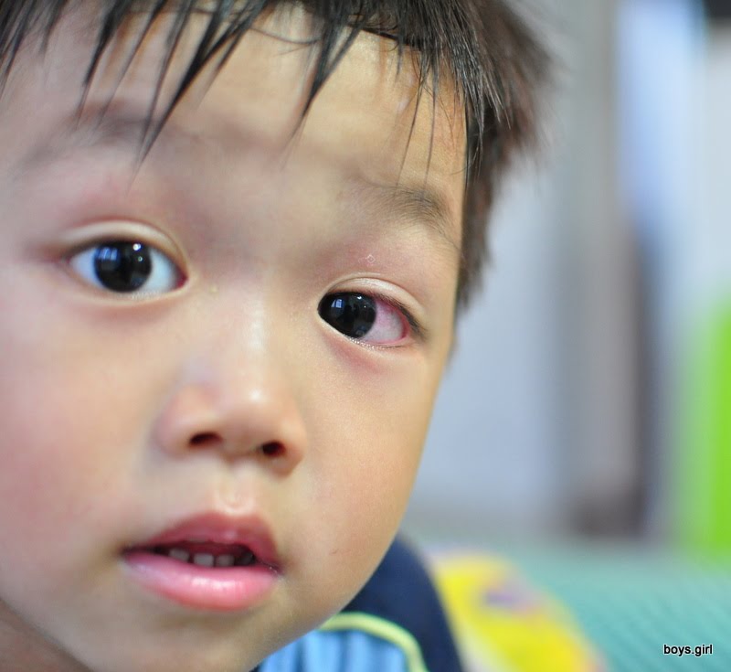 SengkangBabies: Kids update - his Eye and her Poo