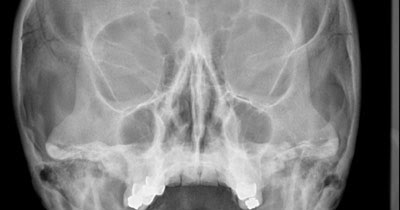 Sinusitis y el sobre diagnóstico en radiografías simples de senos ...