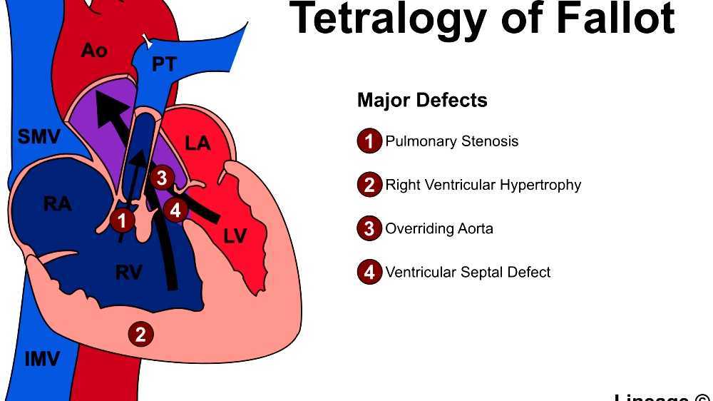 Tetralogy of Fallot