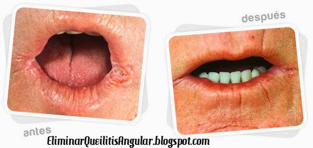 ¿Como Curar Las Boqueras? | Adios Queilitis Angular: CONSEJOS PARA QUE ...