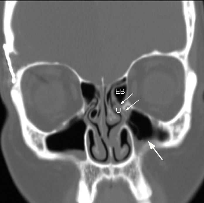 Radiologist For Ever: Paranasal sinuses rule 3 :Causes of sinus ...