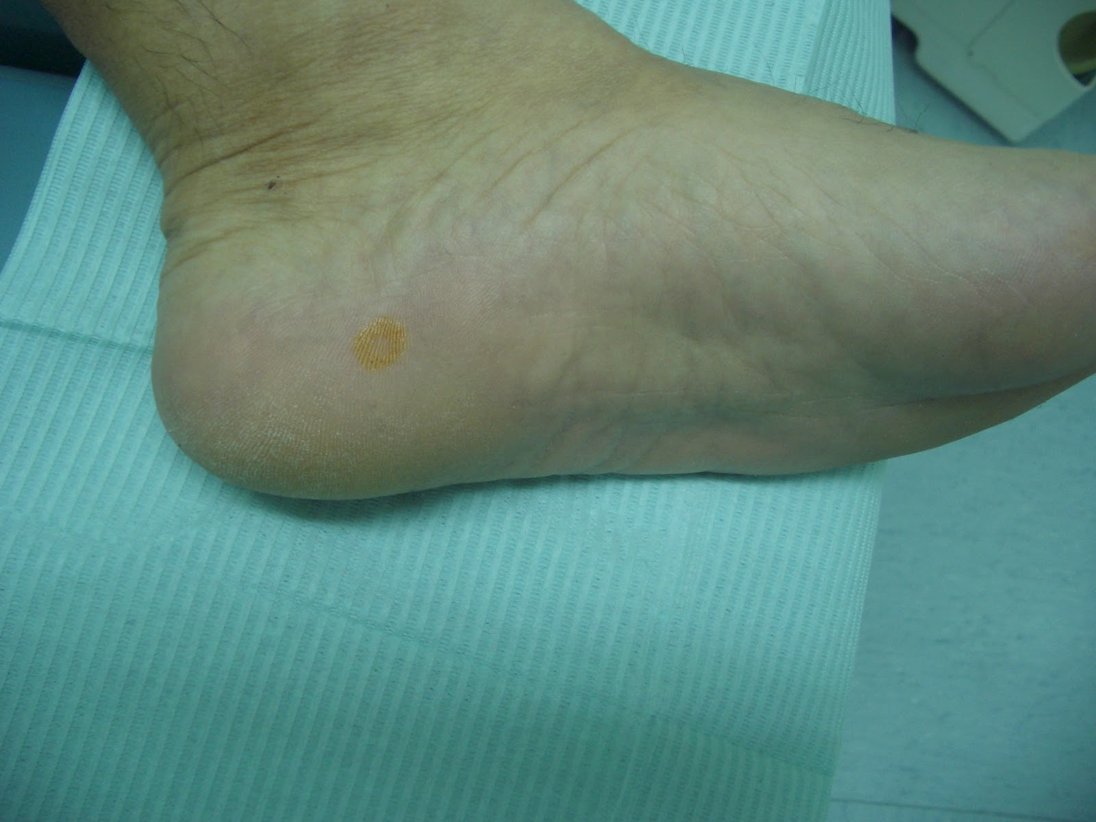 Podo Basas al Día: Fascitis plantar. Micosis intertriginosa. Papiloma ...