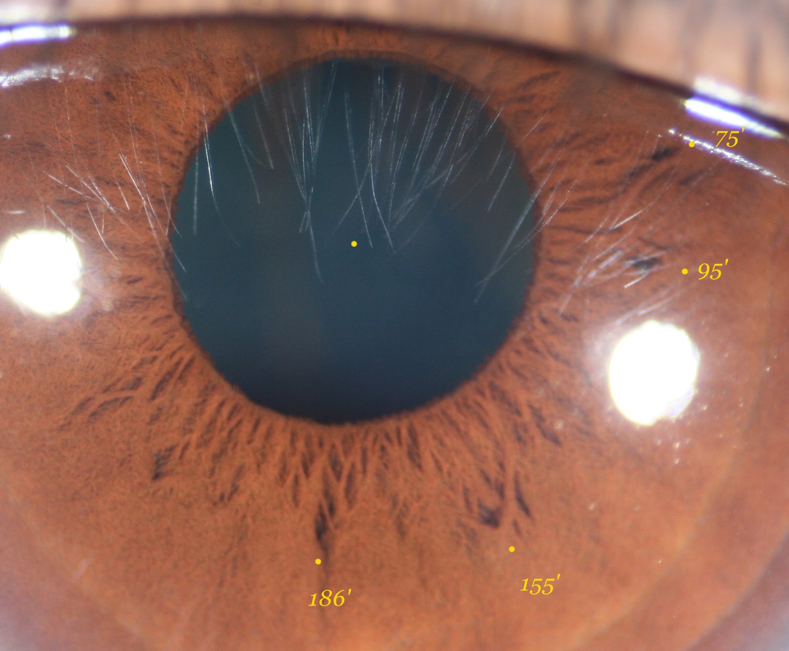 Modern & Multidimensional Iridology: Crypts at Pupillary Zone ...