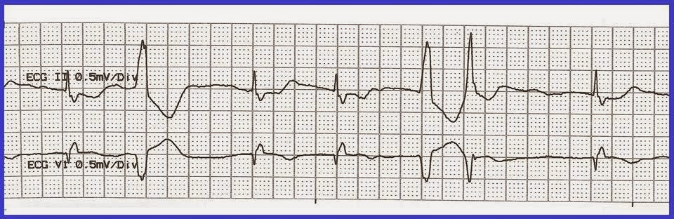 Various Atrial Fibrillations