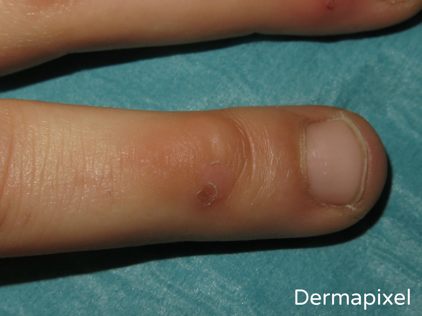 Dermapixel: junio 2017