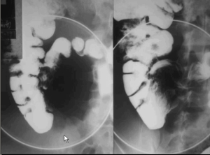 Trânsito Intestinal