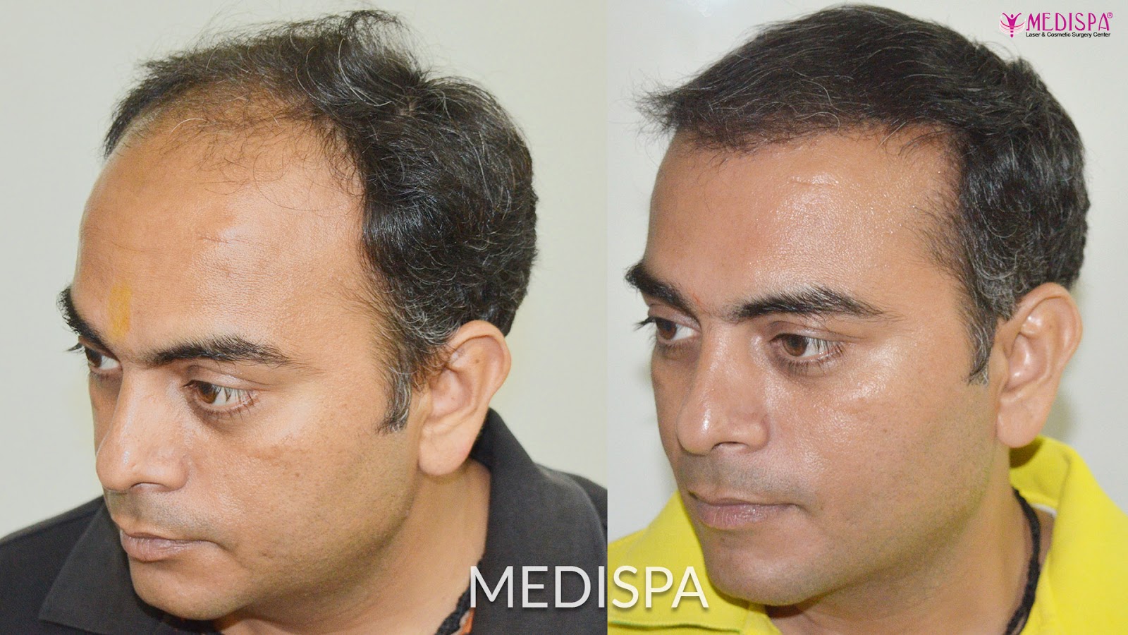 Hair Transplant In Dubai Hair Transplant Cost
