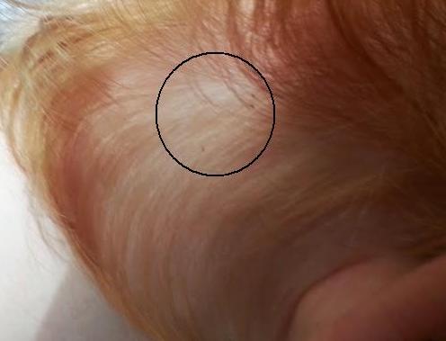 The Brick Castle: Head Lice for Beginners