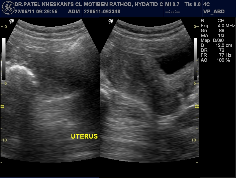 Exclusive Findings in Radiology and Imaging: Multiple Hydatid Cysts In ...