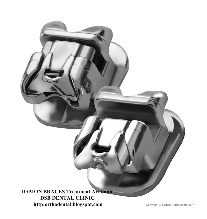 DAMON System Braces by: DSB DENTAL CLINIC