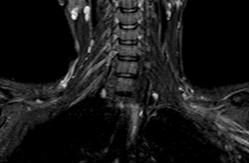 Brachial Plexitis -MRI - Sumer's Radiology Blog