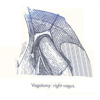 OTMANAGE: VAGOTOMY PROCEDURES 1