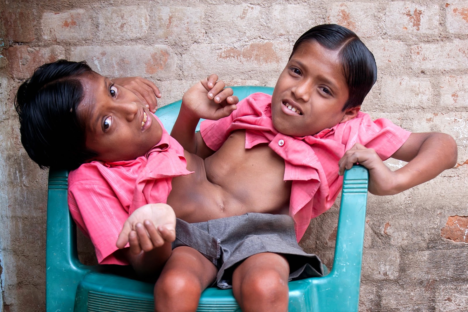 Amazing Indian Conjoined Twins : They Don't Want To Be Separated | Most ...