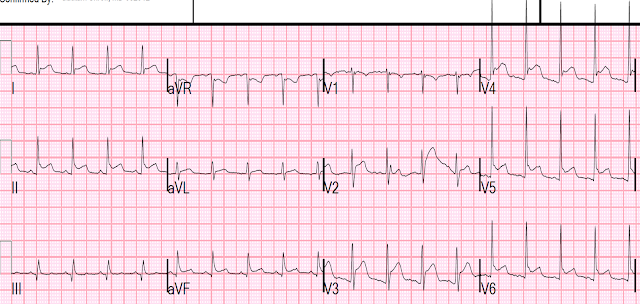Dr. Smith's ECG Blog: ECG of pneumopericardium and probable myocardial ...