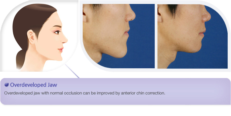 BK Plastic Surgery: [BK Plastic Surgery] Protruding Chin Correction