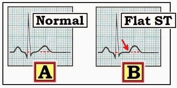 ECG Interpretation: ECG Interpretation Review #84 (ST Depression – ST ...