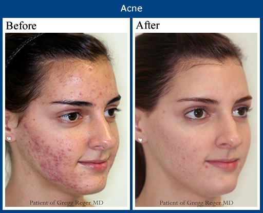 Young and Healthy Skin: Revolutionary Acne Scar Removal Cream