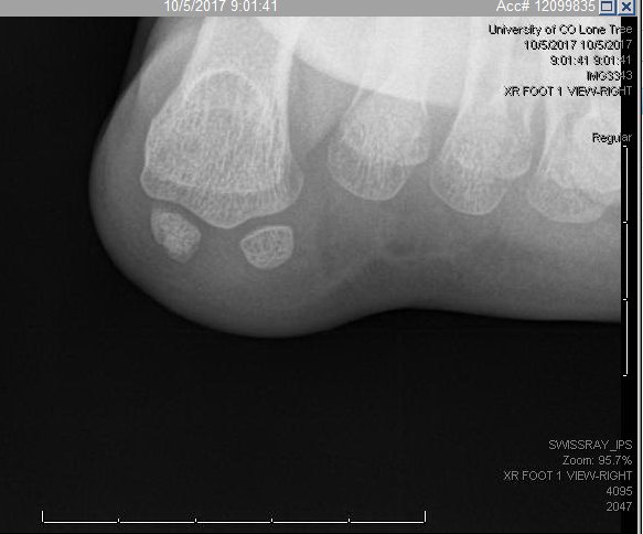 Foot and Ankle Problems By Dr. Richard Blake: Sesamoid Injury in a ...