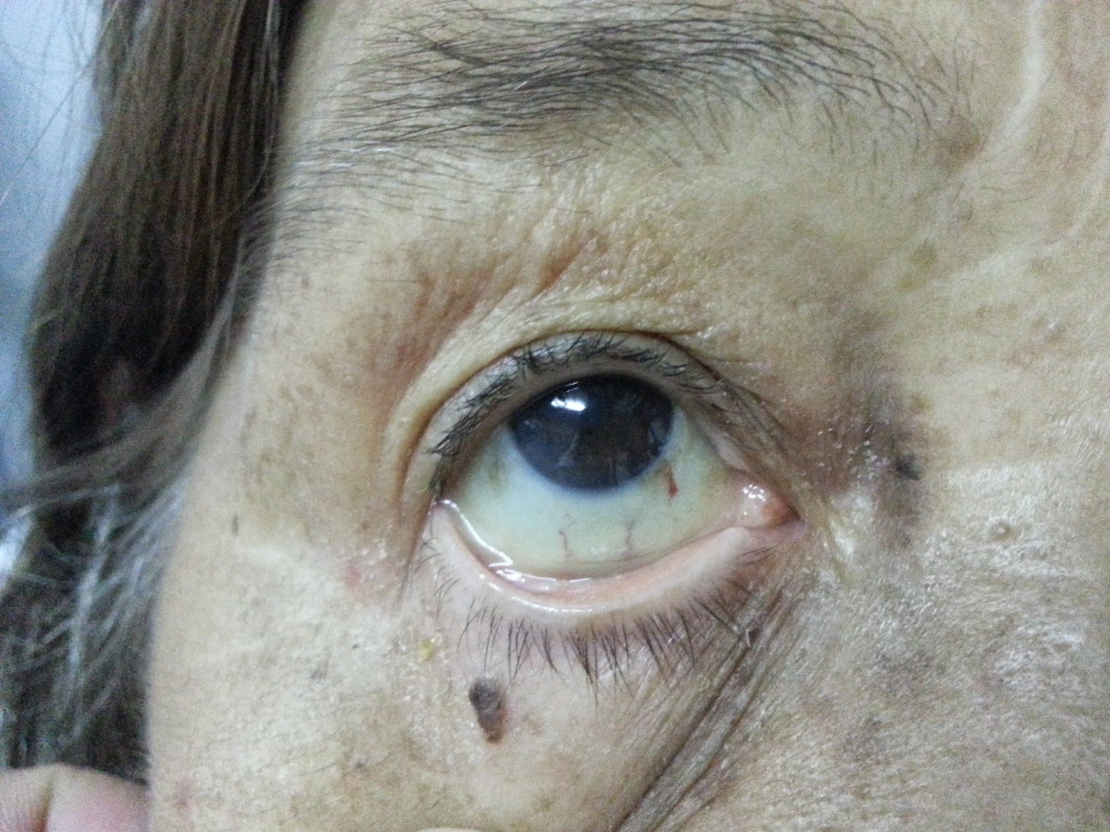 EL RINCÓN DE LA MEDICINA INTERNA: ANEMIA PERNICIOSA, A PROPÓSITO DE DOS ...