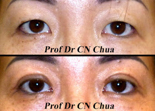 Eyelid Surgery by Prof Dr CN CHUA 蔡鐘能: Case 1: Doctor, Why Are My ...