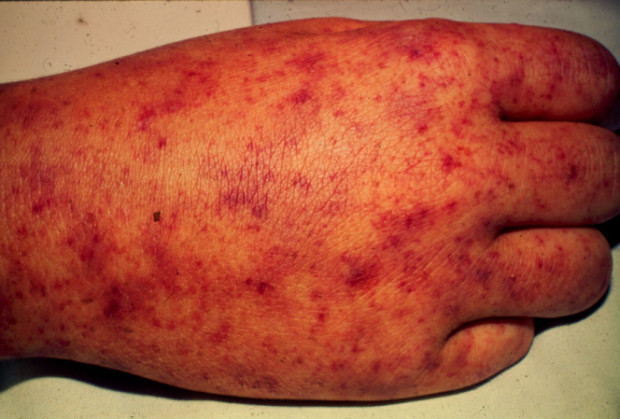 Lecture Notes in Medical Technology: Lecture #15: RICKETTSIA, CHLAMYDIA ...