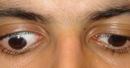 Silent sinus syndrome Symptoms, Causes, Treatment, Surgery - Health ...