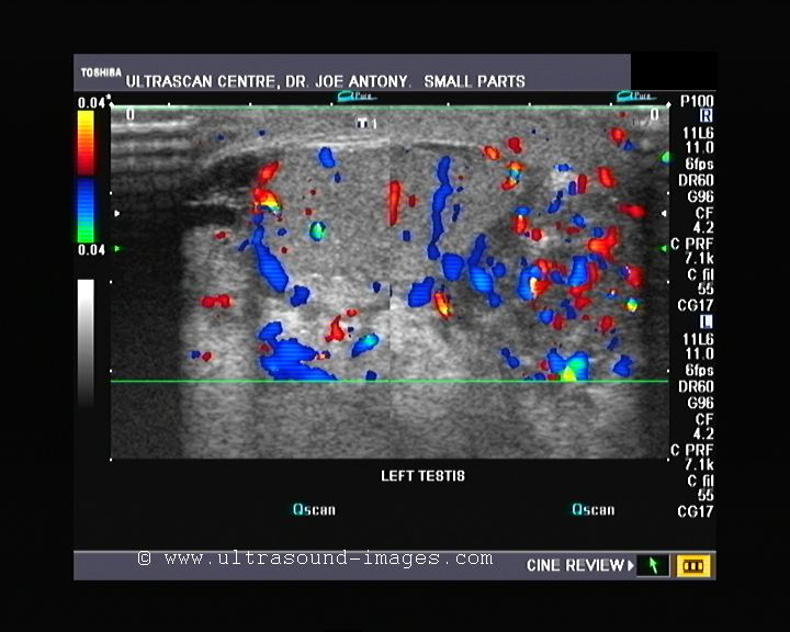 Ultrasound Imaging Orchitis Left Testis