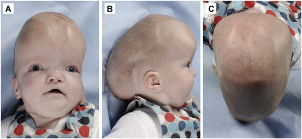 Hello USA: frontal bossing