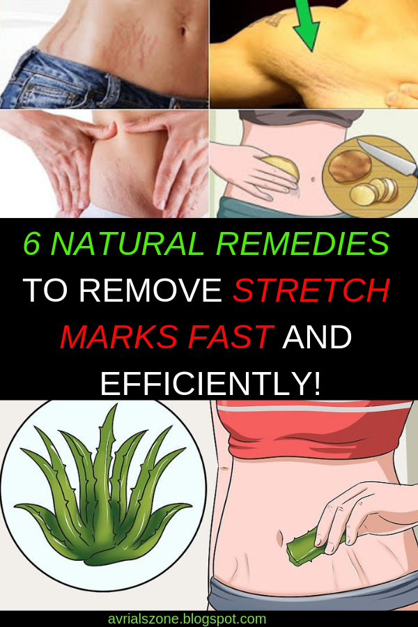 Healthy Beauty and Diet: 6 NATURAL REMEDIES TO REMOVE STRETCH MARKS ...