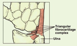 TFCC (Triangular Fibrocartilage complex) tear: Triangular ...