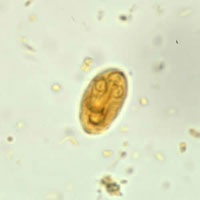 Giardiasis