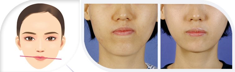 BK Plastic Surgery: [BK Plastic Surgery] Facial bone contouring: Facial ...