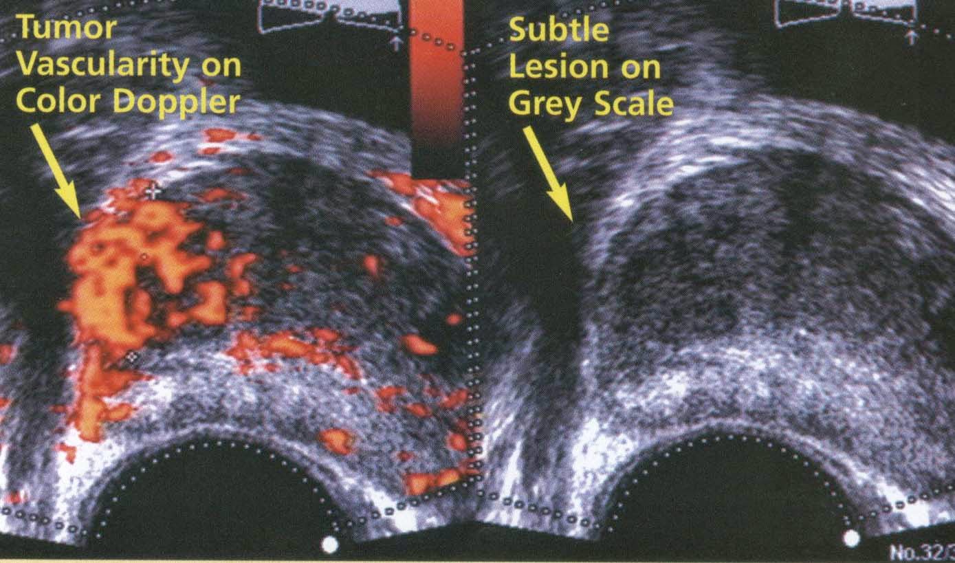 Medicine weekly: New imaging technique for prostate cancer